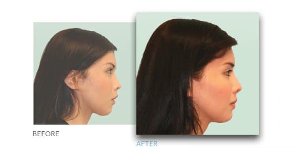 Cheek Reduction - Plastic Surgery Thailand