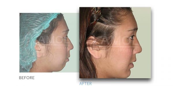 Chin Contouring and Chin Reduction - Plastic Surgery Thailand