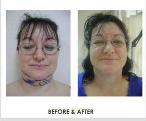 Chin Contouring and Chin Reduction – Plastic Surgery Thailand
